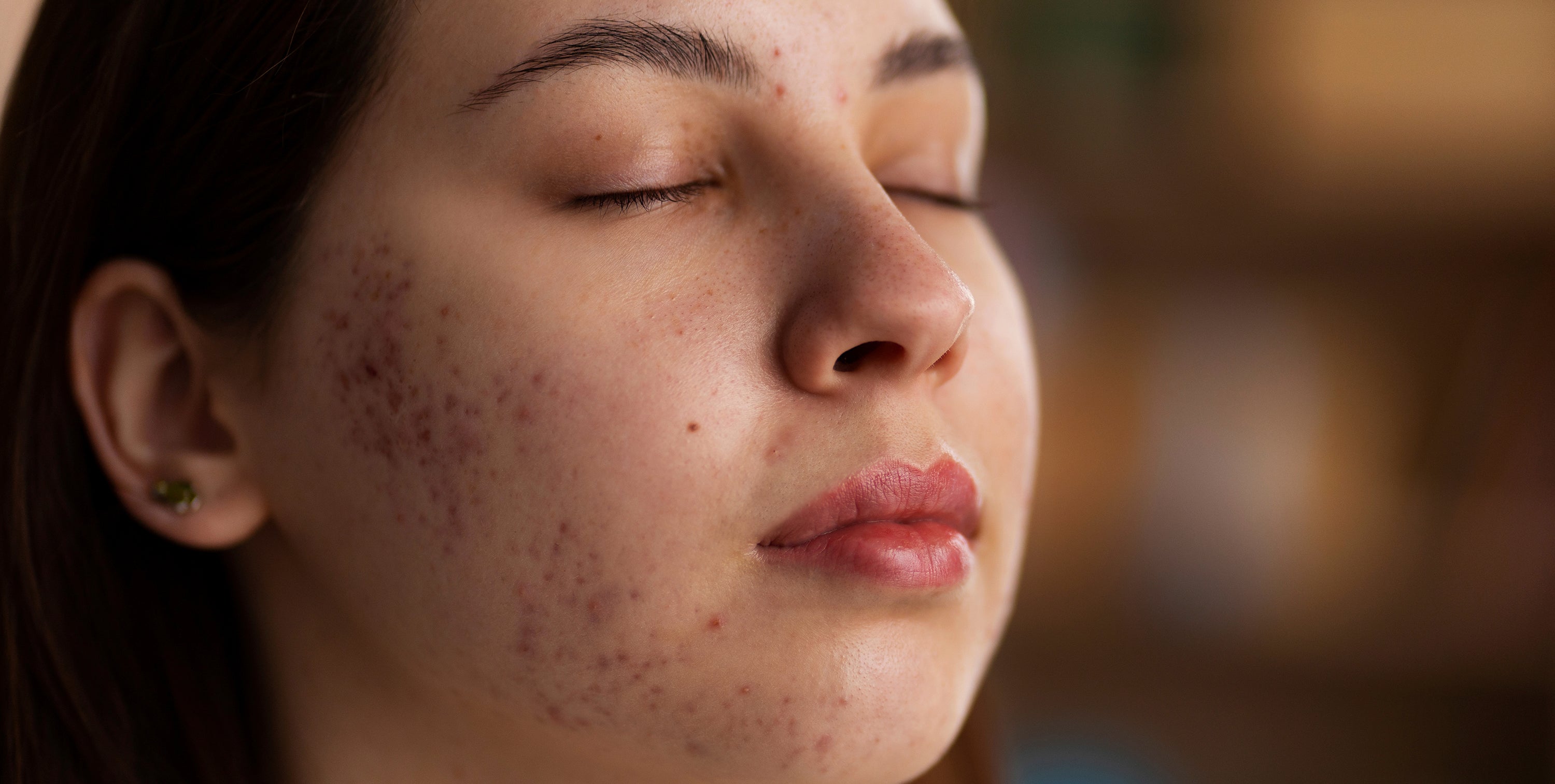 Mitos y realidades del Acné – Dermaexpress