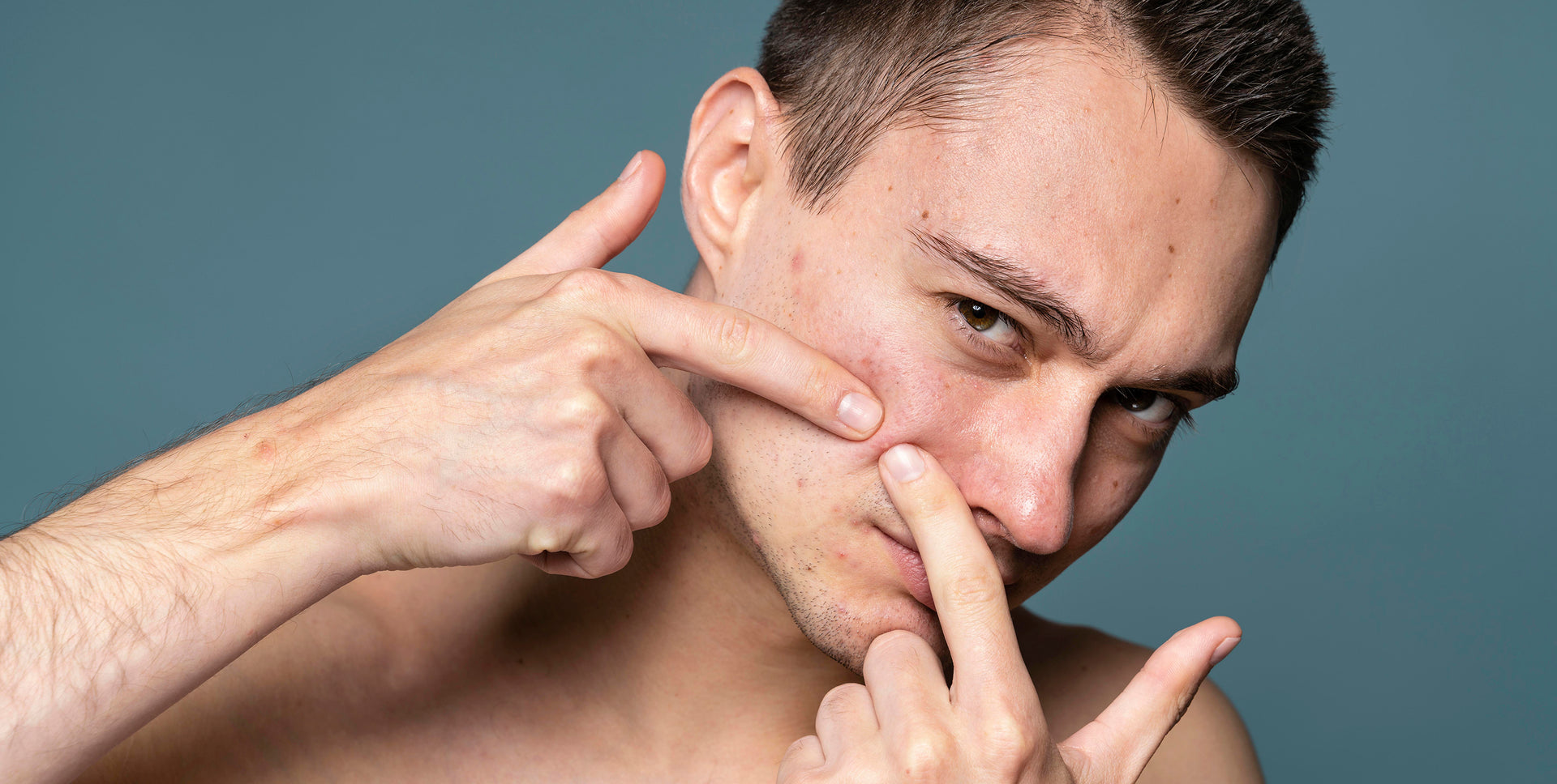 S.O.S ¡Me salió un grano! – Dermaexpress